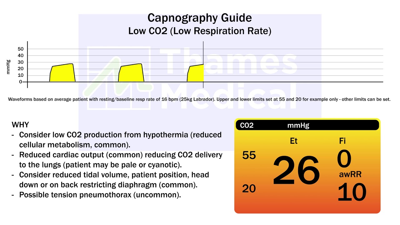 Capnography Waveform Library - Thames Medical Ltd.