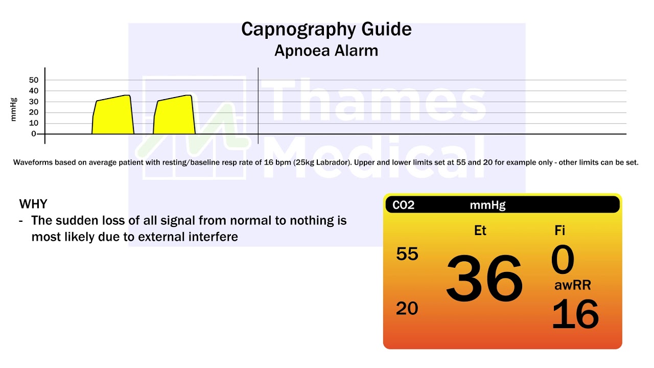 Capnography Waveform Library - Thames Medical Ltd.