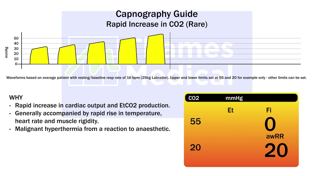 Capnography Waveform Library - Thames Medical Ltd.
